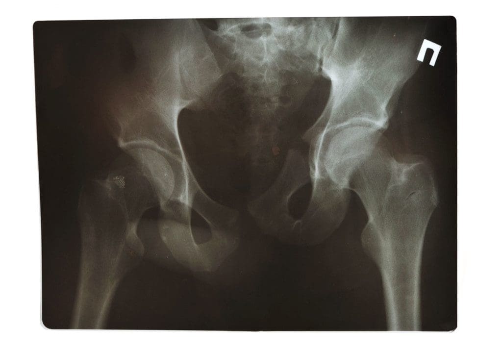 Sacral Fracture - El Paso, TX | Sciatica Pain and Treatment Clinic